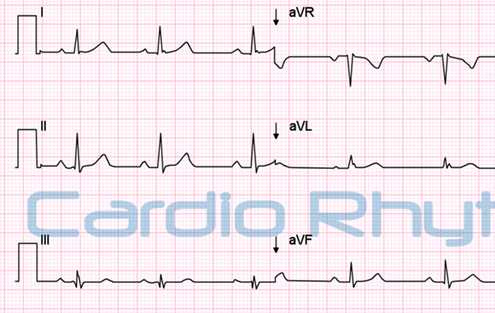 CVT Mohd Farid: ECG Basic:Cardiac Axis-Credit Cardio Rhythm Online Blogspot