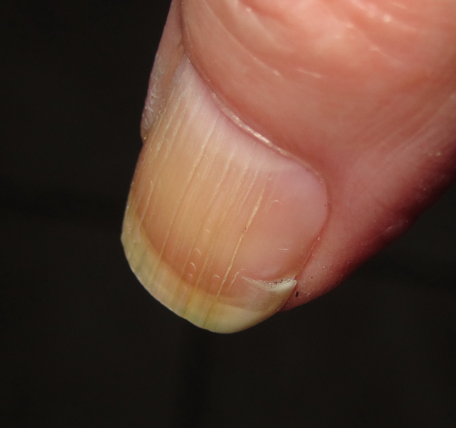 Marias Nail Art and Polish Blog: 1½ months of repairing a ripped/torn ...