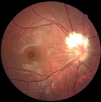 Diagnose My Retinal Photograph: Myelinated Nerve Fiber Layer - Eyedolatry