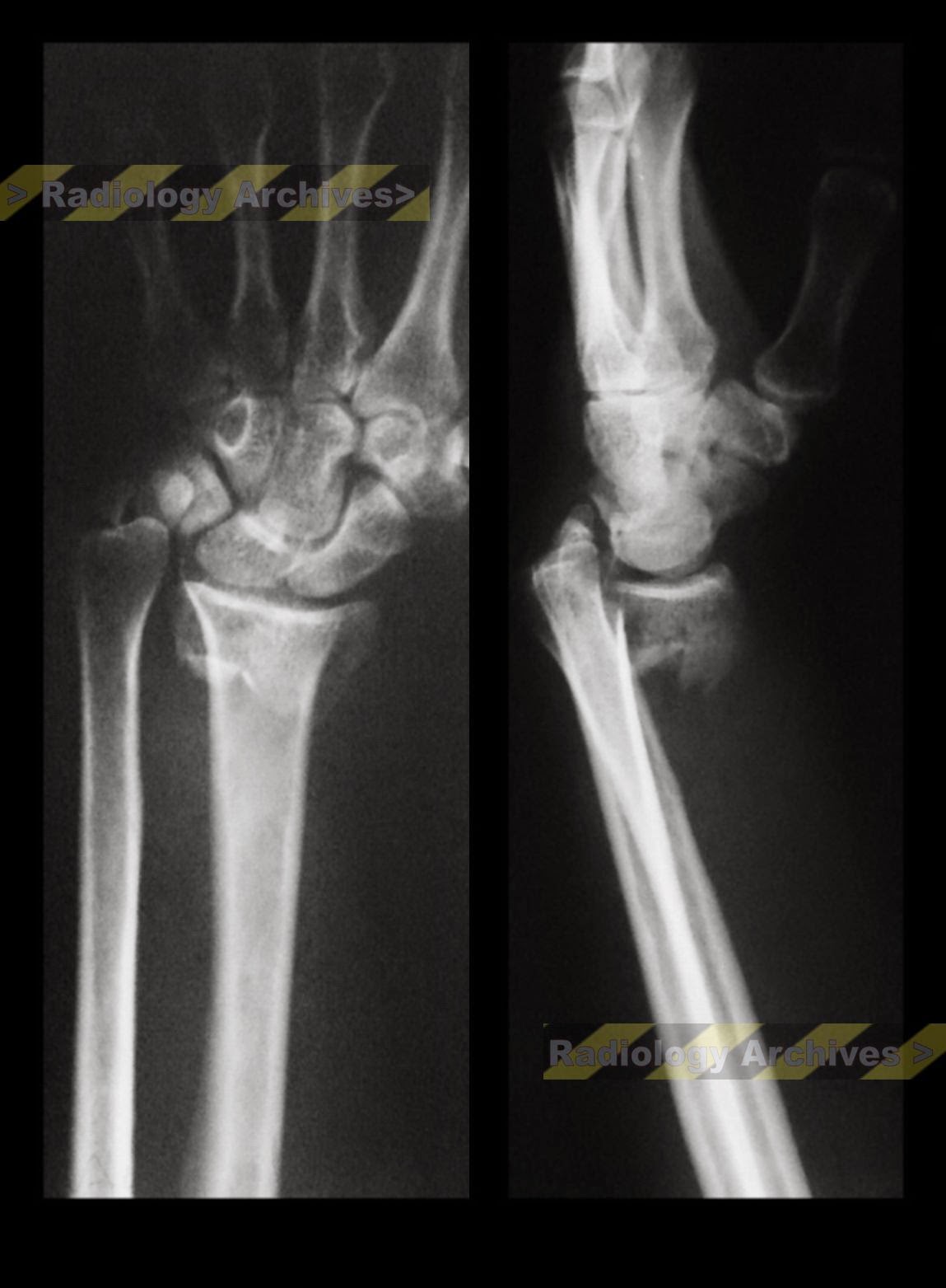 Radiology Archives: Κάταγμα Smith*