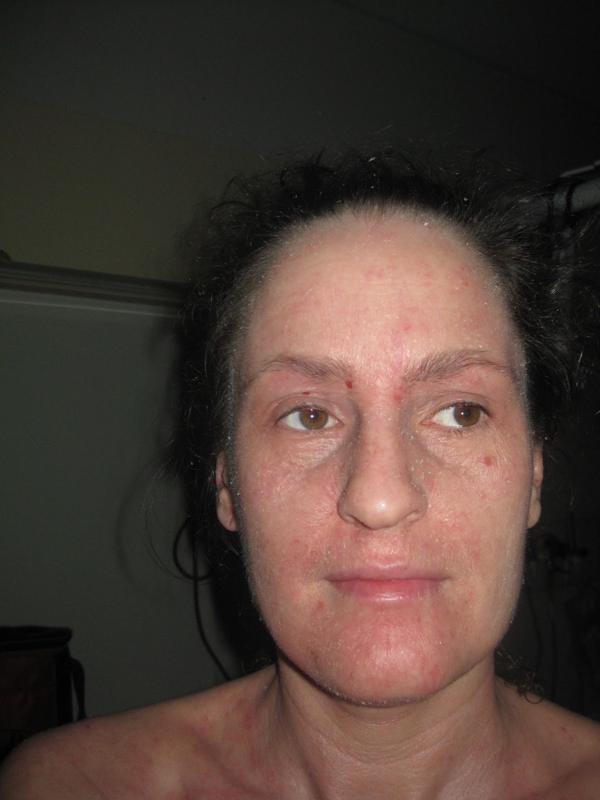 Topical Steroid Withdrawal Journey-Healing Eczema and Red Skin Syndrome ...