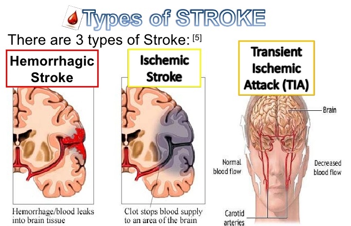 The Real Faces Of Elder Abuse MAY IS STROKE AWARENESS MONTH the-real-faces-of-elder-abuse-may-is-stroke-awareness-month
