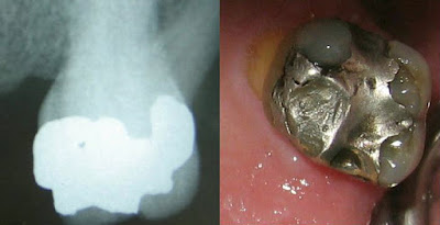 Dentosphere : World of Dentistry: MCQs on Dental Materials : Amalgams ...