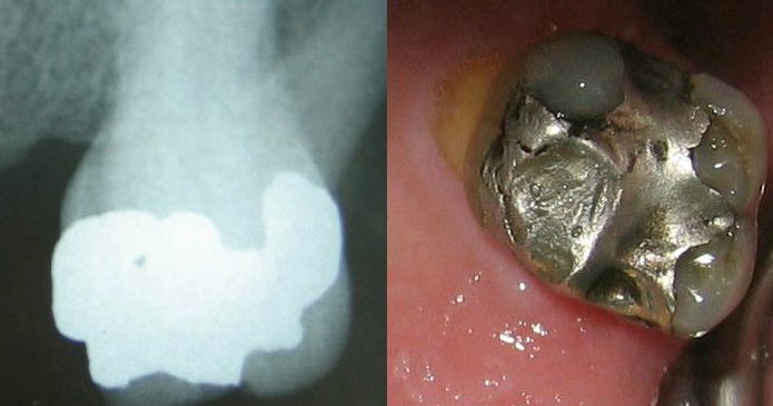 Dentosphere : World of Dentistry: MCQs on Dental Materials : Amalgams ...