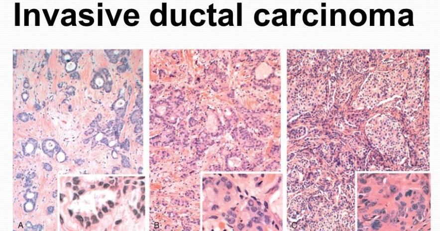 Invasive Ductal Carcinoma