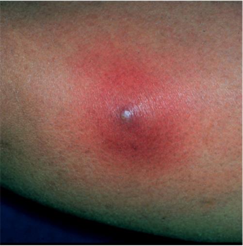 Tucson Shuttlecock , Jual Shuttlecock Bagus dan Murah: Penyebab Sakit ...