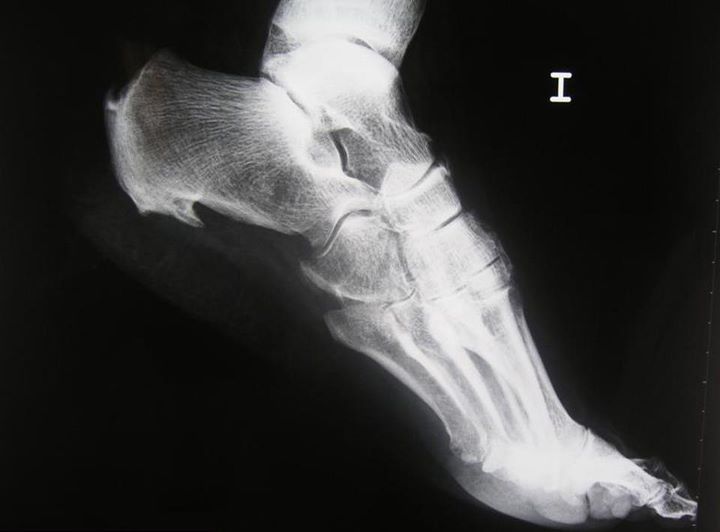 Podologa sida sidonia: Bursite de Aquiles