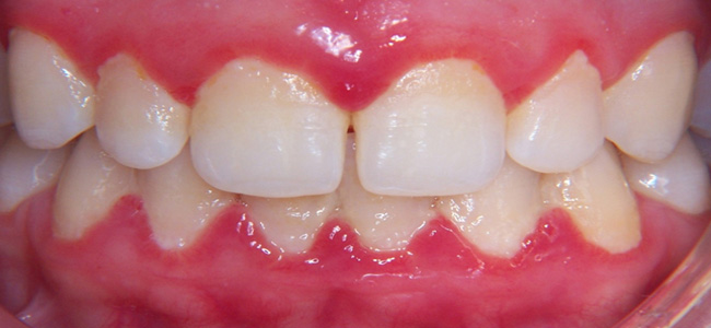Clinica Dentaria Mais Sorriso: O que é gengivite? Sinais e sintomas
