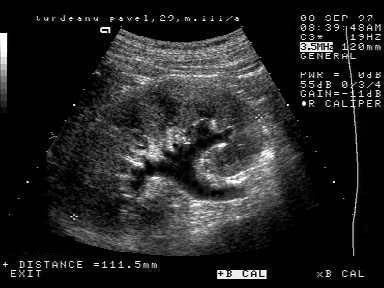 ecografie imagini medicina renal Renal nativ Hidronefroza | Terapii ...