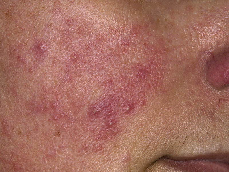 Rosacea En La Cara Tratamiento - Signos y Dieta a Seguir - Rosacea ...