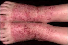 Mengenal eksim dan penanganannya - Nectur