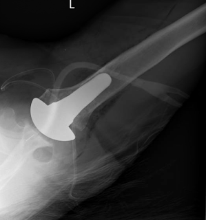 Shoulder and Elbow Surgery: Impaction autografting of the medial calcar ...