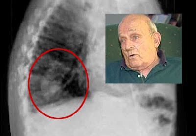 tambaysamaykanto: If you inhale a pea in can sprout and grow in your lungs