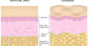 Weight Loss Help: Cellulite