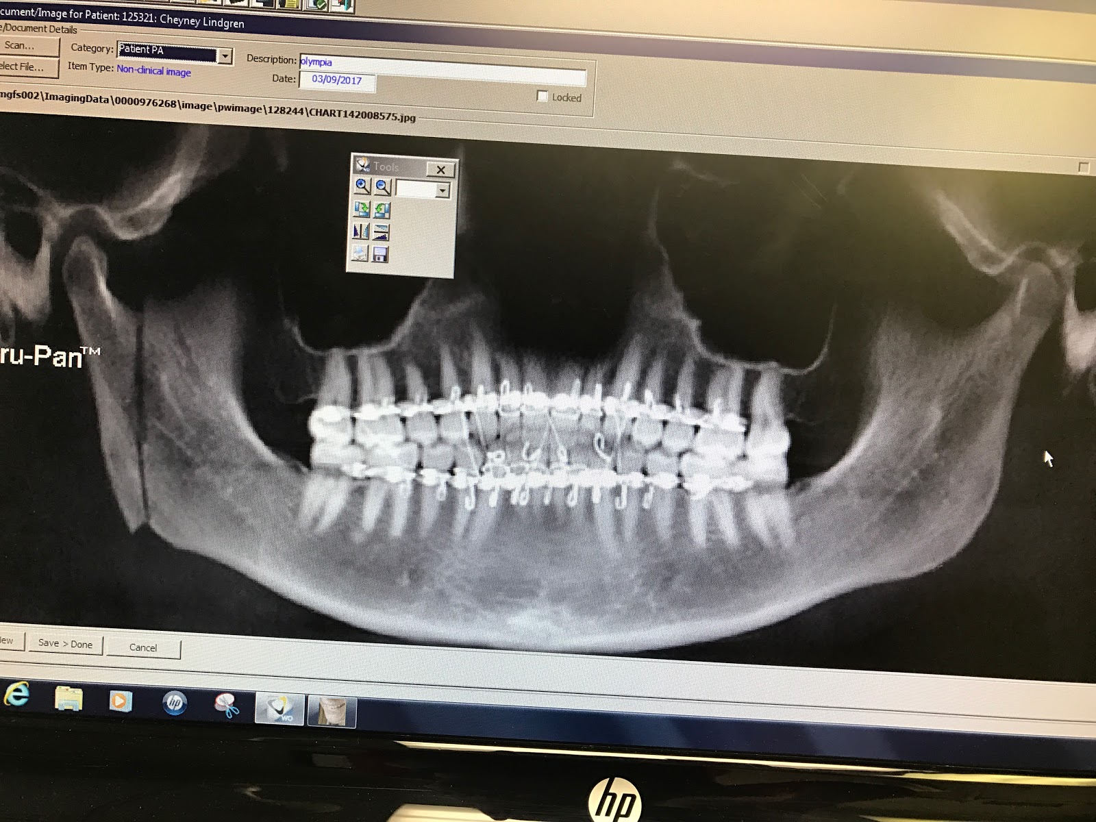Cheyney and Ryan's Blog: Intraoral vertical ramus osteotomy