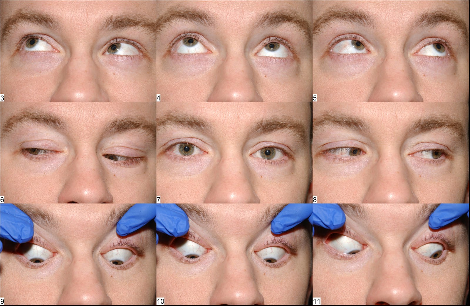 StrabismusRounds: 4/3/13 Cases