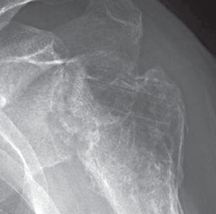 UW Shoulder and Elbow Academy: Humeral head osteotomy in shoulder ...