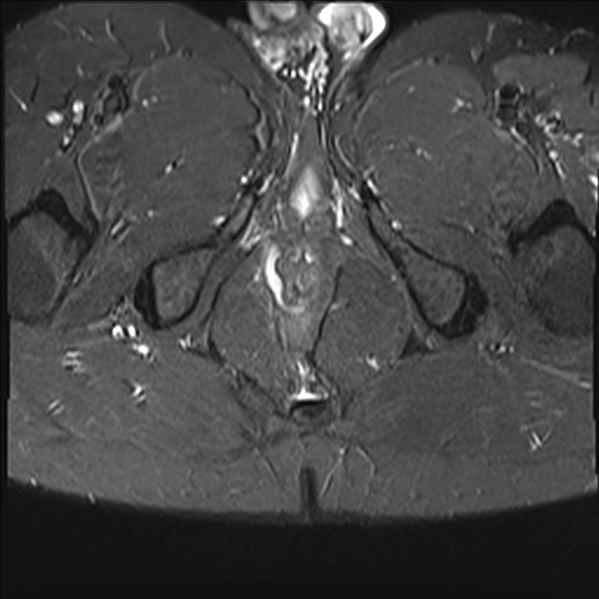 Ultimate Radiology : Grade 3 ( Trans-Sphincteric) Perianal Fistula