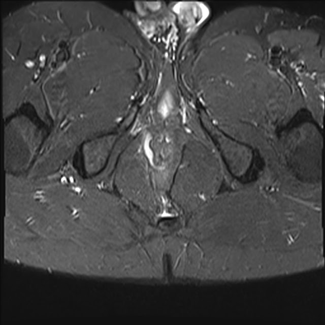 Ultimate Radiology : Grade 3 ( Trans-Sphincteric) Perianal Fistula