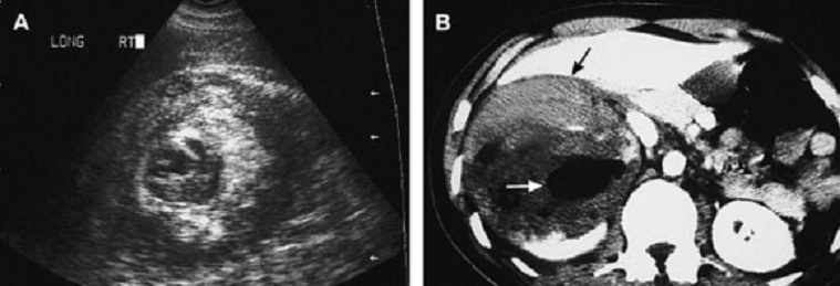 Renal Ultrasound Cases (Adrenal haemorrhage, Perinephric haematoma ...