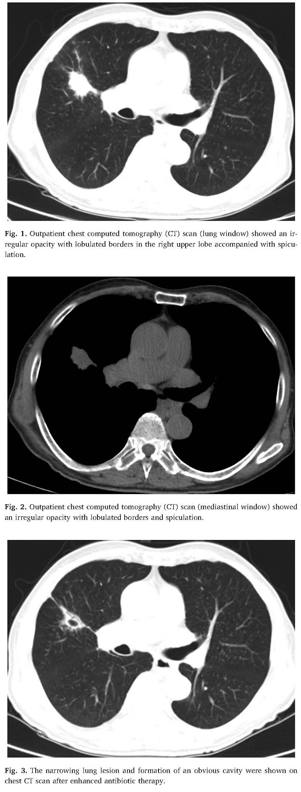 画像診断センター: An unusual case of lung abscess secondary to round pneumonia ...