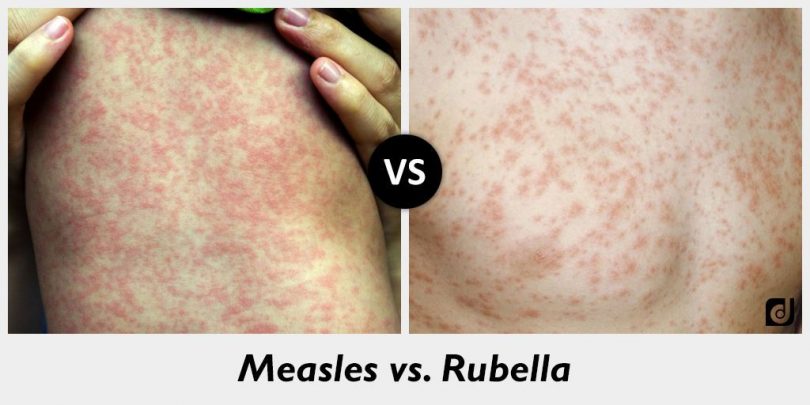 quiz comptetion about measles and rubella virus (urdu )