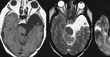 Brain and Spines: Extra axial cerebral masses and DWI