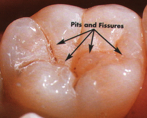 FAMILY CARE DENTAL: FISSURE SEALANTS
