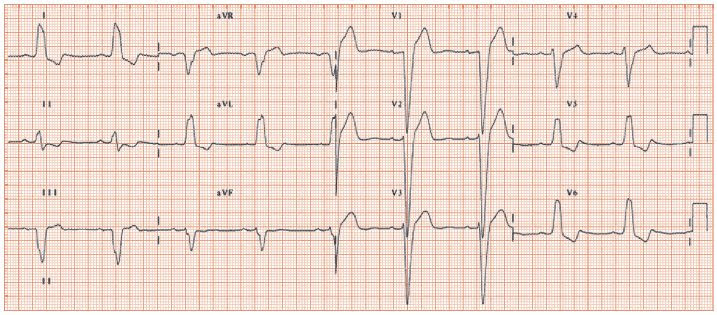 Left Bundle Branch Block (LBBB).