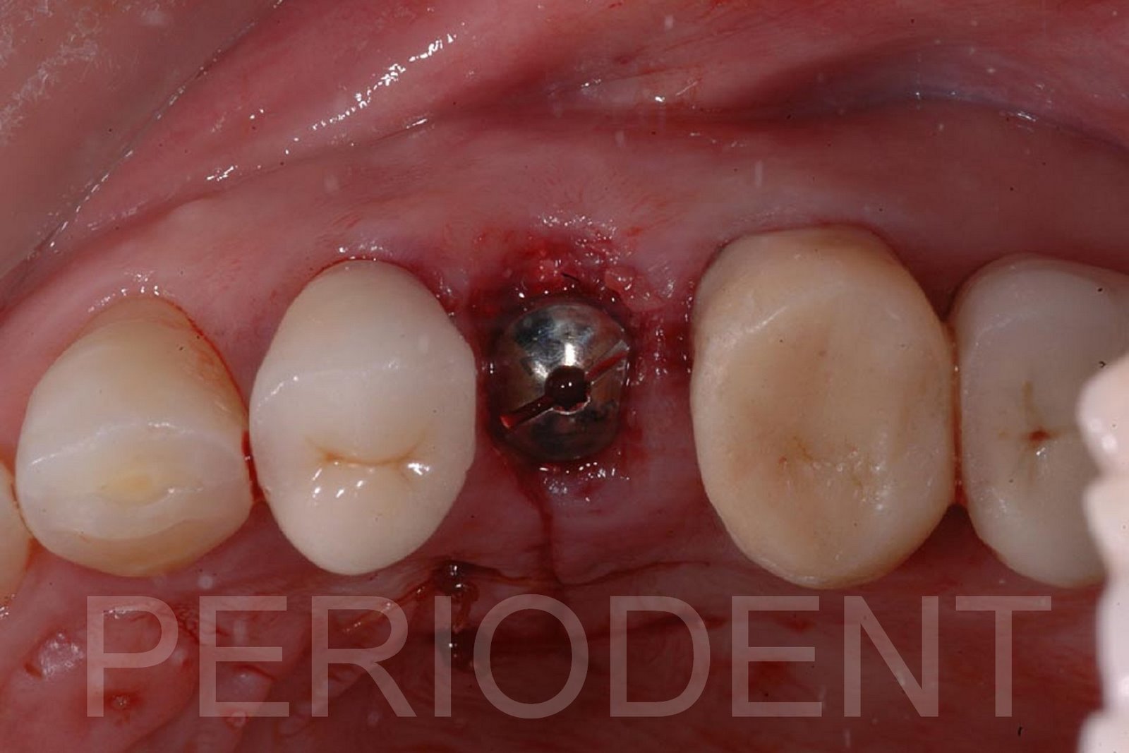 P E R I O D E N T = P E R I O + I M P L A N T: Upper 2nd Premolar ...