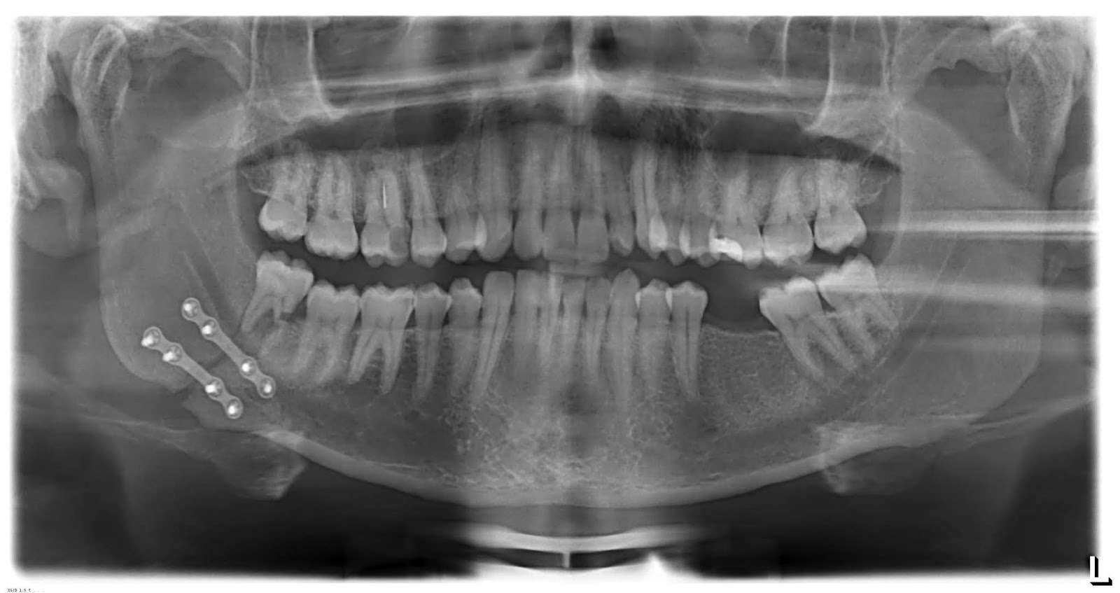 Pós-Operatório de Fratura de Mandíbula - CIRURGIA BUCOMAXILOFACIAL