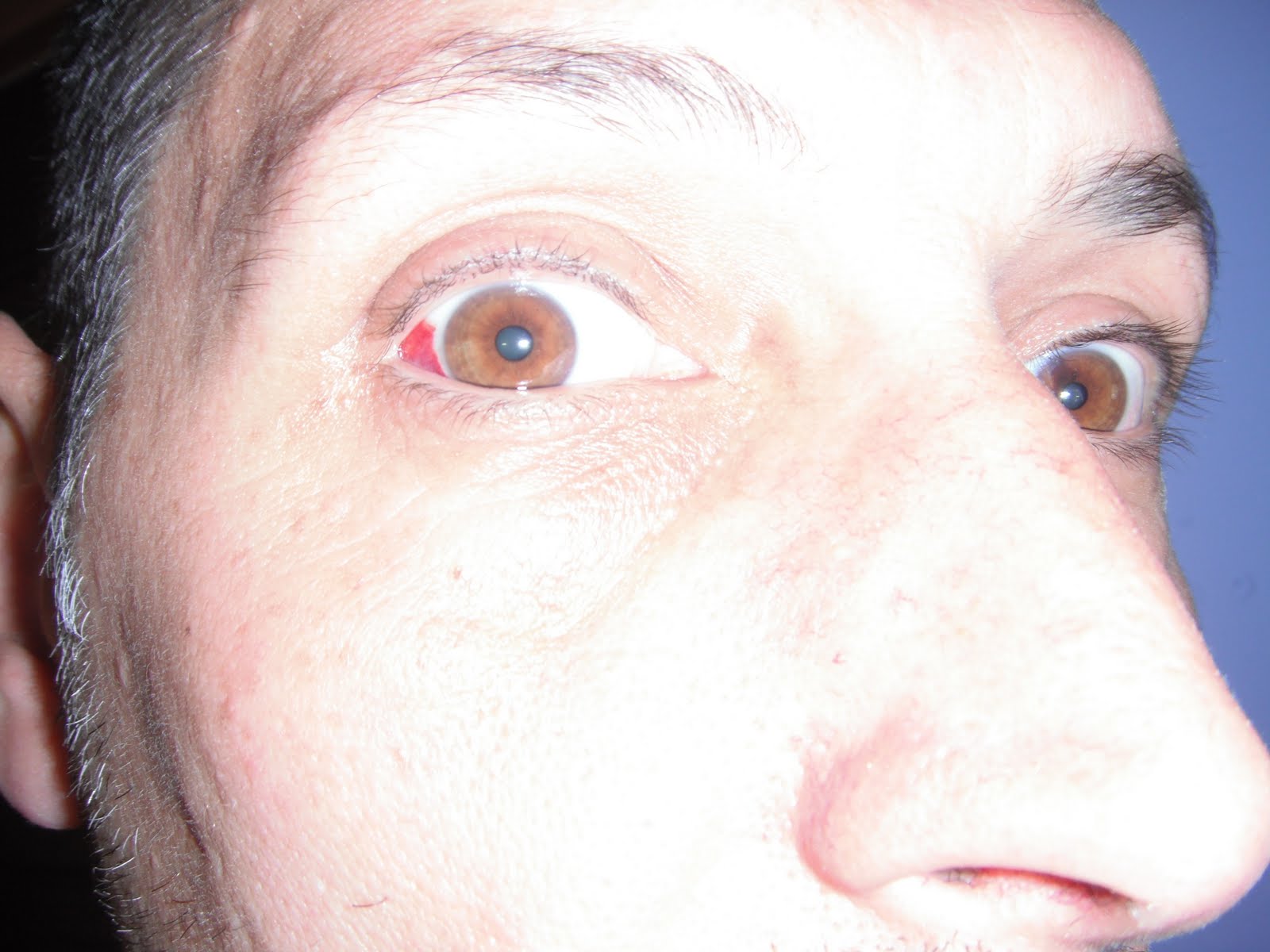 neilwaukee: the eye dying