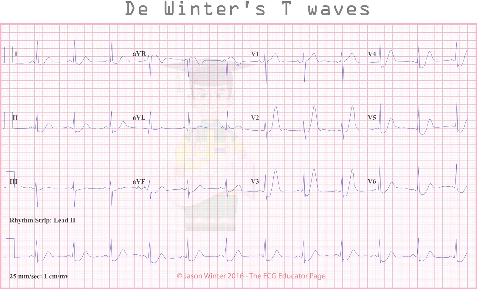 ECG Educator Blog : De Winters T waves