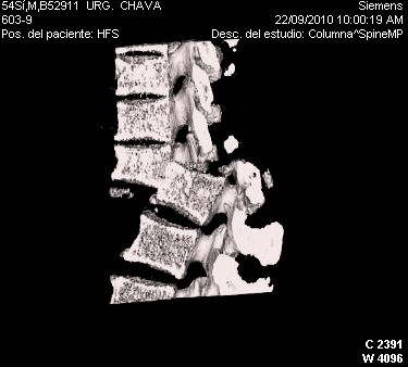 Colegio Mexicano de Ortopedia: Fracture-dislocation of the ...