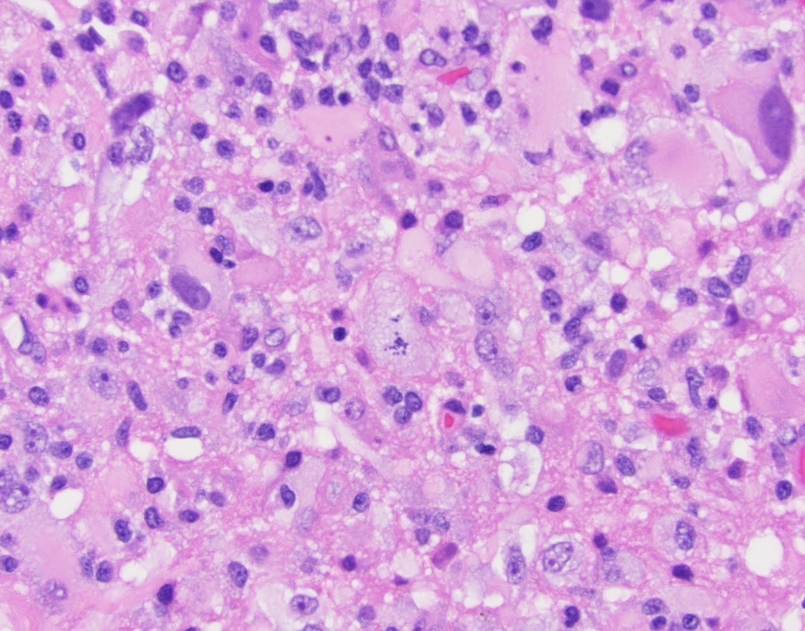 neuropathology blog: Giant cell GBM masquerading as an anaplastic PXA