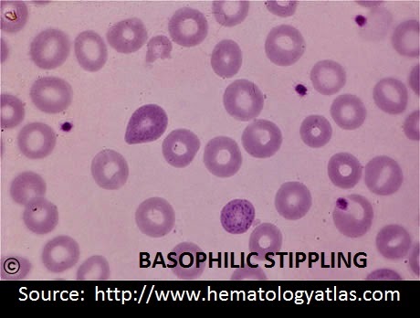 Lab Atlas: Basophilic Stippling