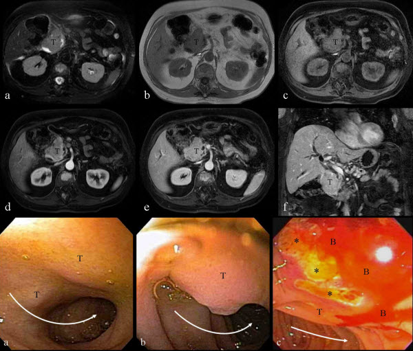 Medical Science: Risk factors of gastric outlet obstruction