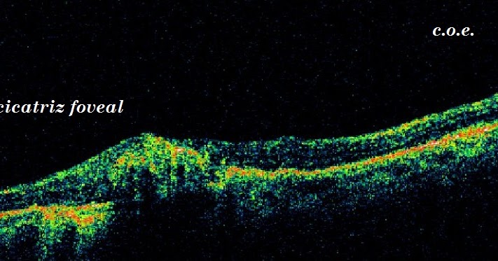DEGENERACION MACULAR : OCT retina V