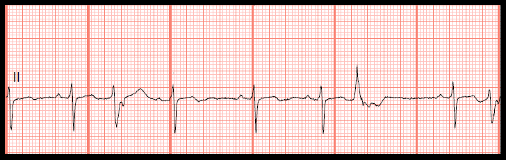 Various Rhythms with Multifocal PVCs
