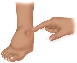 Health Info93: Swollen Feet (Edema): Causes and Treatment