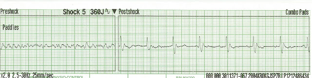 Pulseless VF/VT Part 4