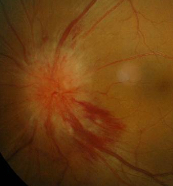 Ungsoo S. Kim: What are differences between NAION and optic neuritis