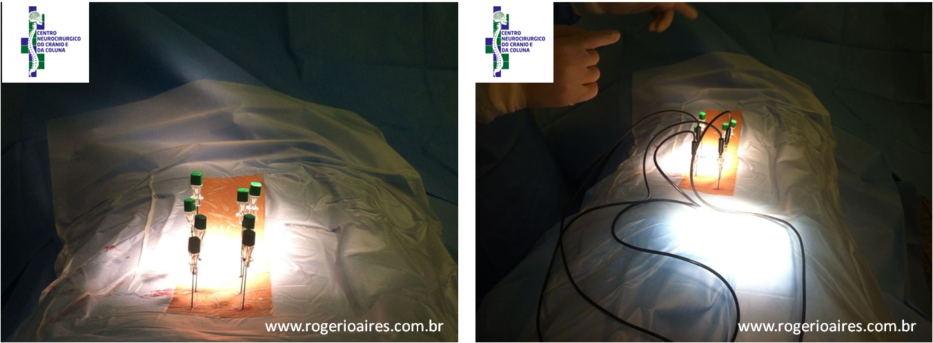 Dr Rogério Aires: RIZOTOMIA PERCUTÂNEA POR RADIOFREQUÊNCIA - TRATAMENTO ...