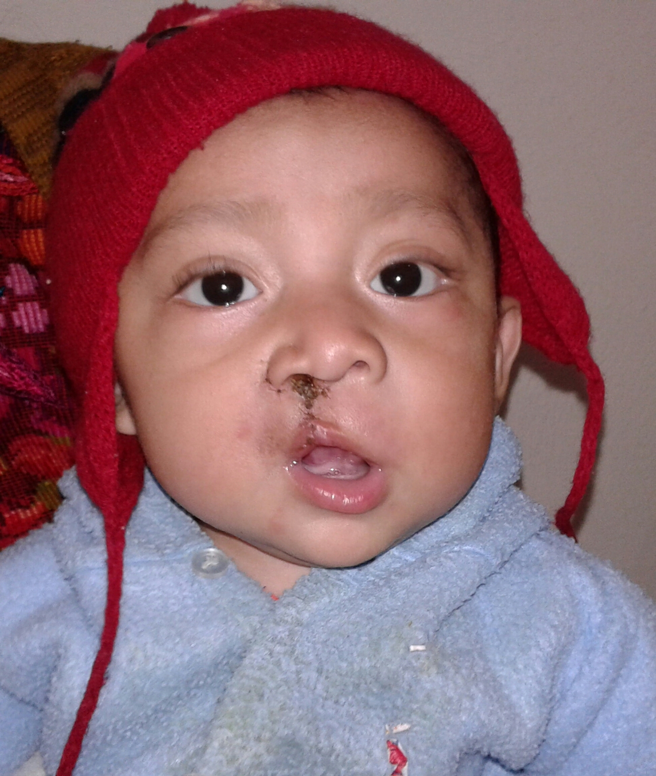 SheriinGuate: Babies One Week Post-Op