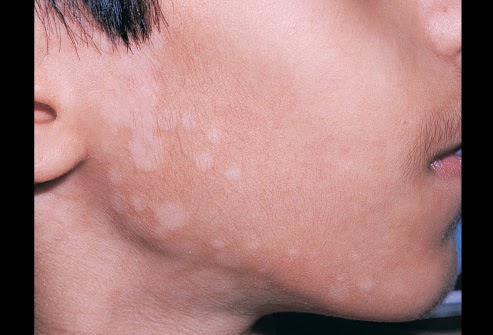 Health and Life: Tinea Versicolor