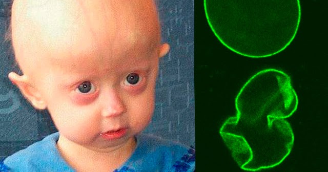 PROGERIA,IMPLICACIONES SOCIALES Y MEDICAS.