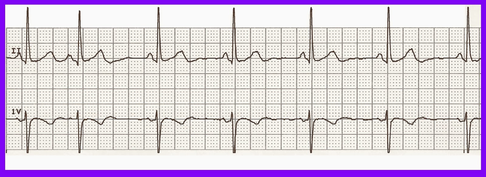 EKG Rhythm Strip Quiz 202