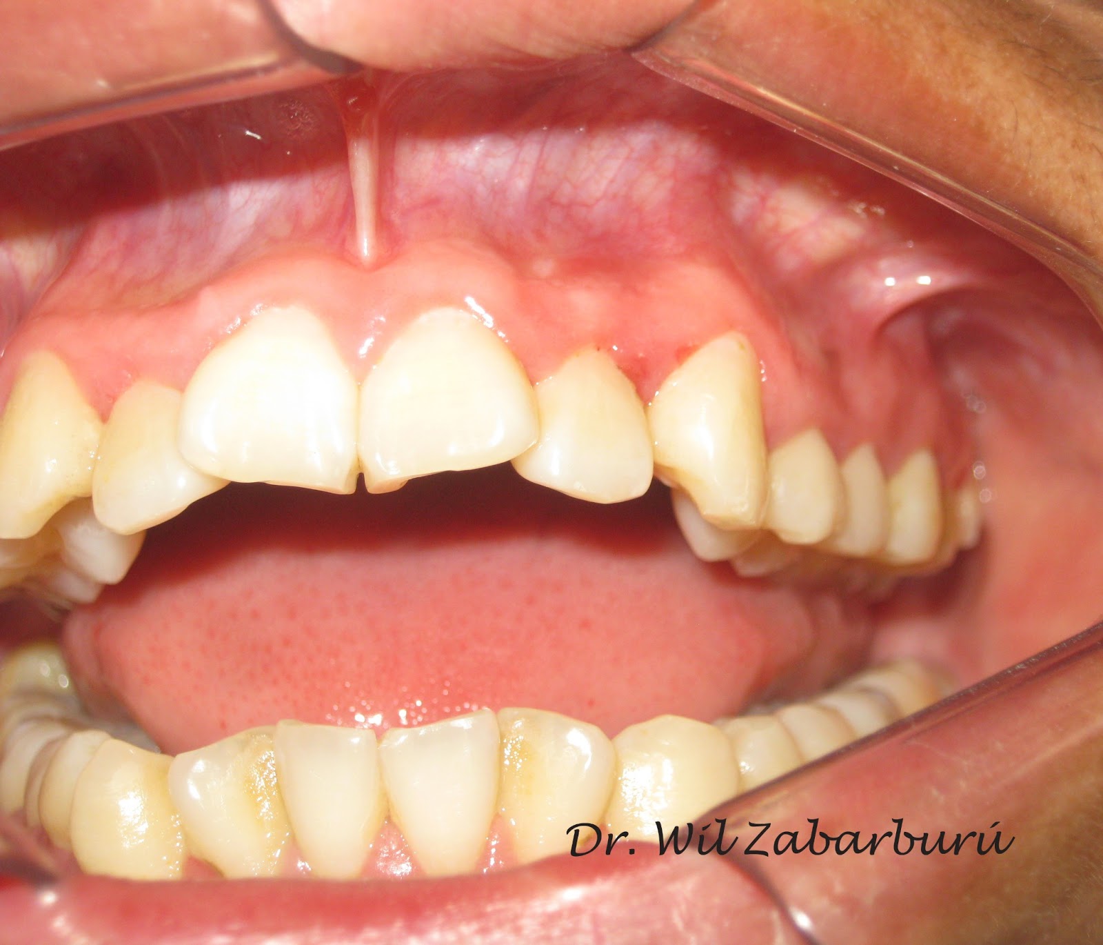 CLINICA DENTAL ASISTENCIAL: GRANULOMA PIÓGENO CLINICA DENTAL ASISTENCIAL: GRANULOMA PIÓGENO