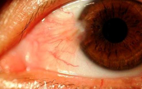 Images For Pterygium ~ YOUNG DOCTORS' RESEARCH FORUM