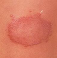 temriye / temre / temri / bir deri hastalığı: Temriye, Temre, Temri Nedir?